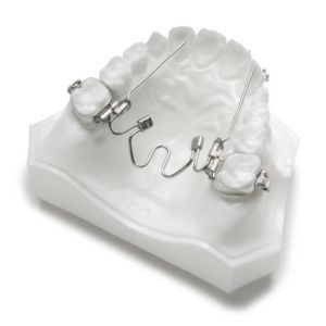 Nitanium Palatal Expander2 (NPE2) Multi-Purpose Finishing Appliance